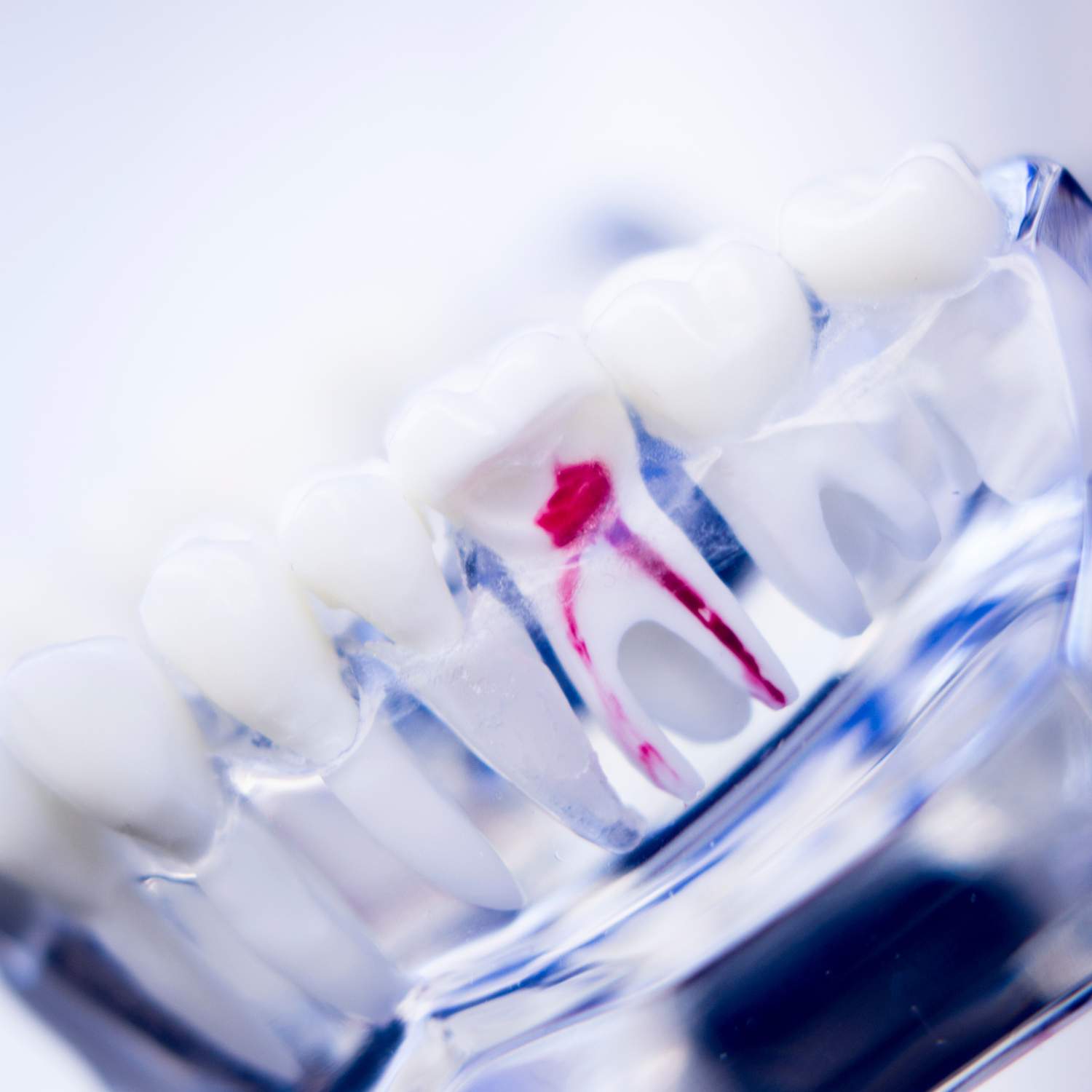 Root Canal Therapy - Heritage Dental Health